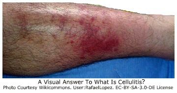 What Is Cellulitis